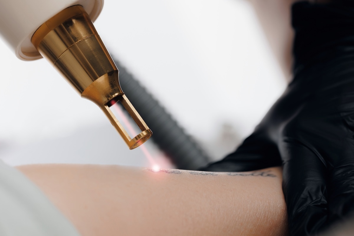 When Tattoo Removal Goes “Suboptimal” – And How to Fix It the Right Way ...